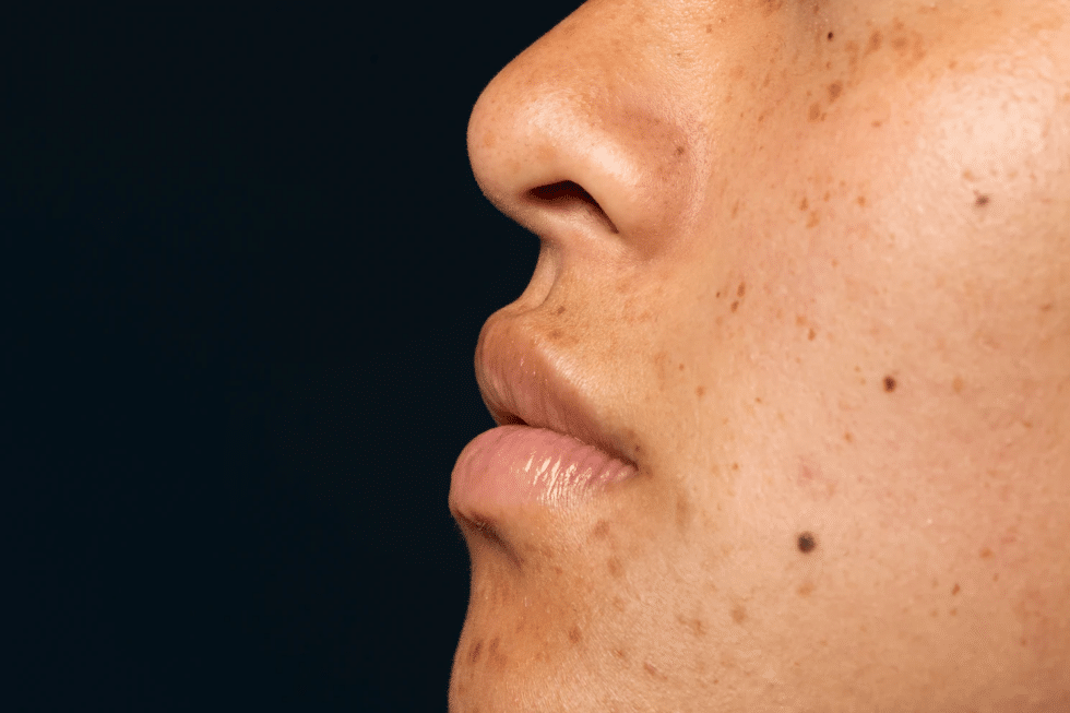 Understanding Brown Spots and Hyperpigmentation - AquaSpa Nuance
